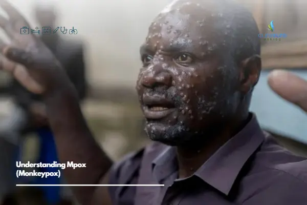 Mpox (Monkeypox): Symptoms, Transmission, Diagnosis, Treatment, and ...