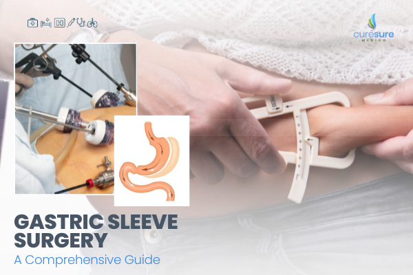 Gastric Sleeve Surgery: A Comprehensive Guide by CureSureMedico