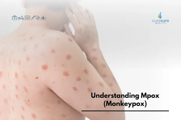 Mpox (Monkeypox): Understanding, Prevention, and Treatment