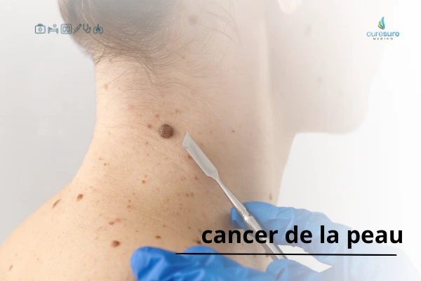 Cancer de la peau : Symptômes, prévention et détection précoce pour ...