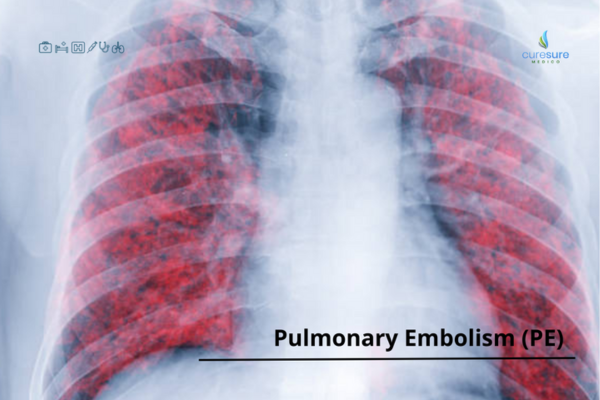 Understanding Pulmonary Embolism (PE): Causes, Symptoms, Treatment, and ...