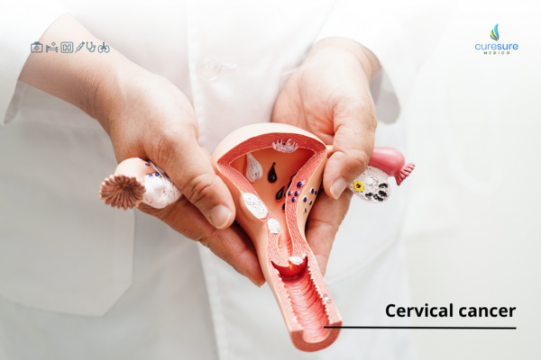 Top Destination for Cervical Cancer Treatment in India: Latest ...