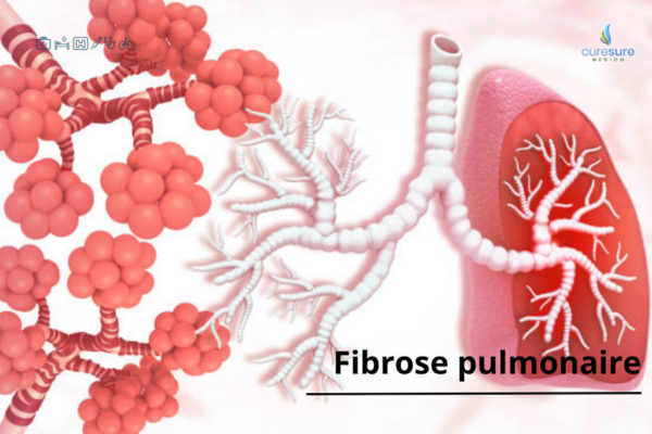 Fibrose Pulmonaire : Symptômes, Causes, Diagnostic et Options de ...
