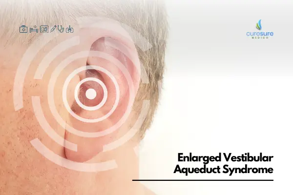 Enlarged Vestibular Aqueduct Syndrome (EVAS): Causes, Diagnosis, and ...