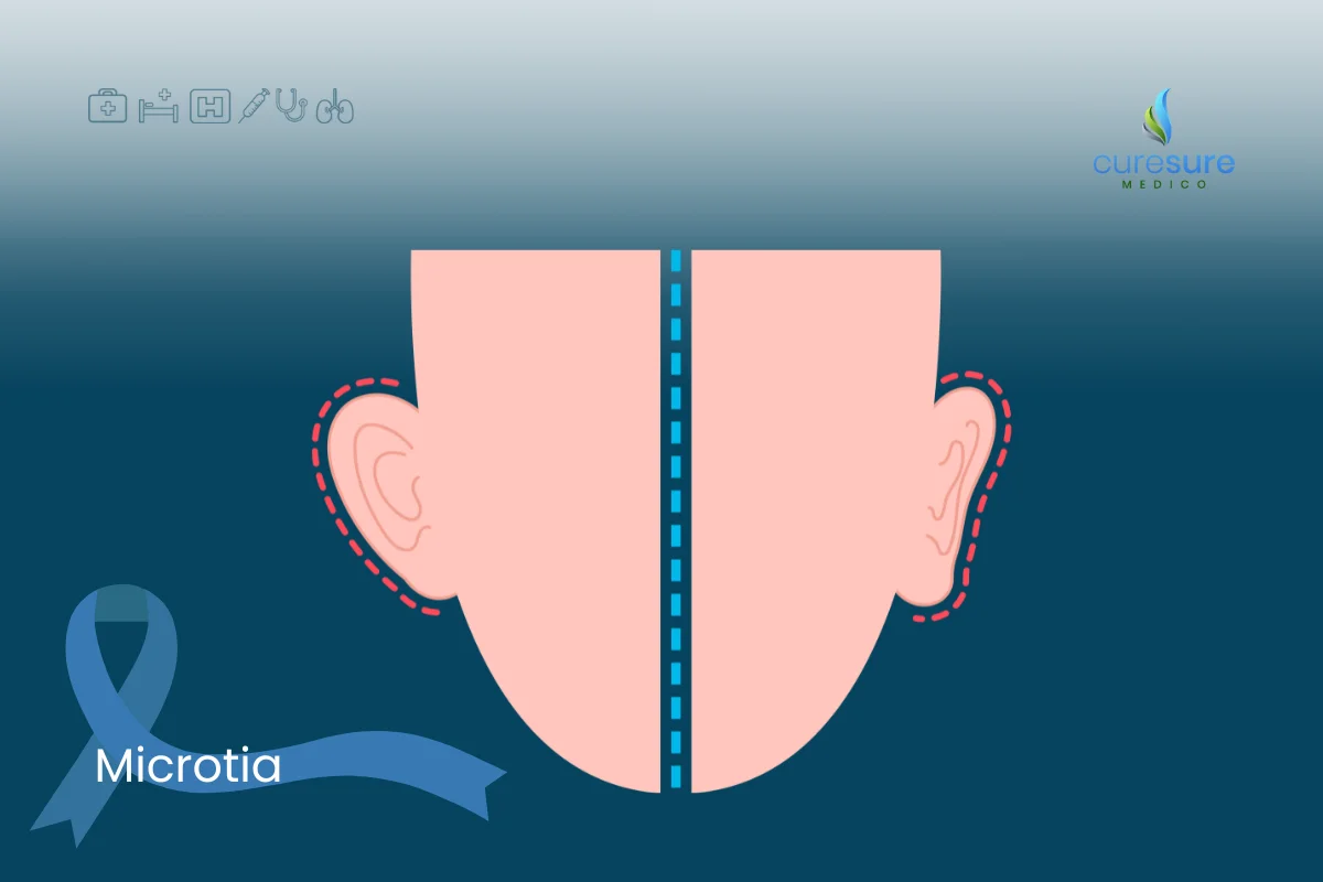 microtia-atresia-causes-treatment