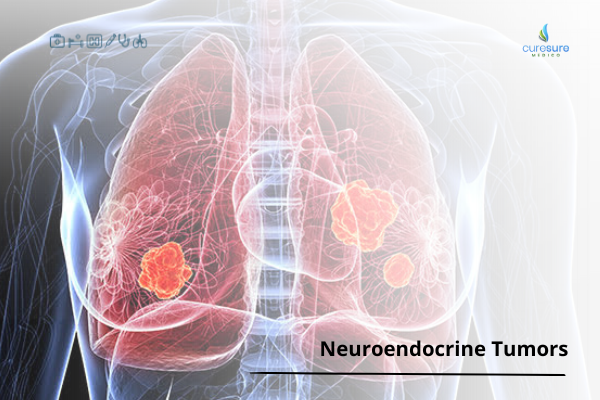 Understanding Neuroendocrine Tumors: Symptoms, Diagnosis & Treatmen