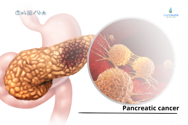 Pancreatic Cancer: Causes, Symptoms, Diagnosis, and Treatment Overview