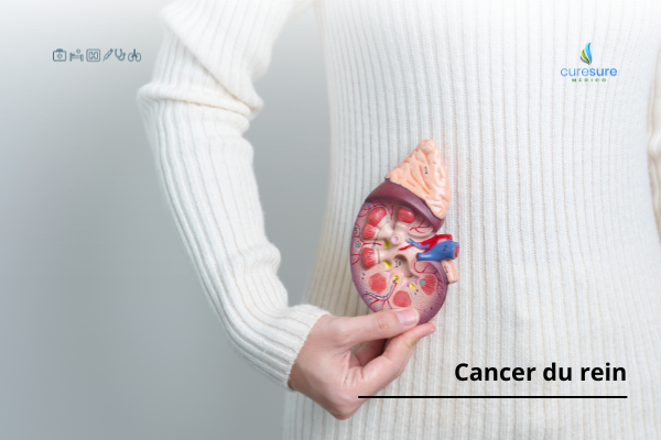 Comment détecter un cancer du rein précocement : signes, examens et ...
