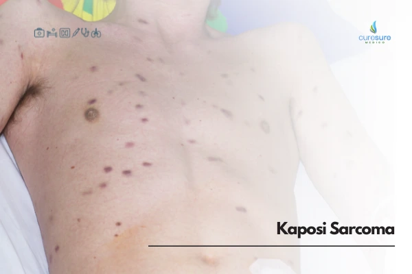 Kaposi Sarcoma: Causes, Symptoms, Diagnosis, and Treatment Options Explained
