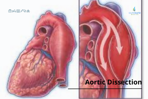 Understanding Aortic Dissection: Causes, Symptoms, Treatment, and ...