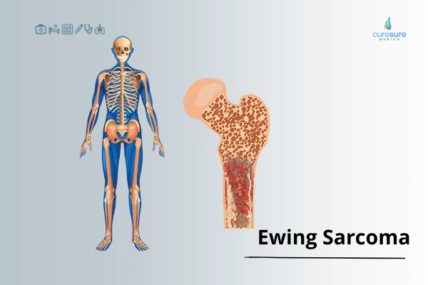 Ewing Sarcoma: A Rare and Aggressive Cancer in Children and Adolescents